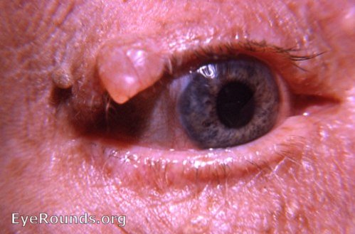 Cyst: cyst of gland of Moll; also, papilloma upper lid. EyeRounds.org ...
