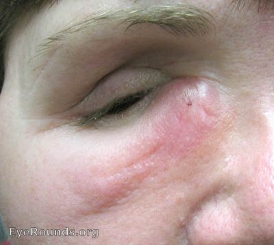 Atlas Entry - Dacryocystitis