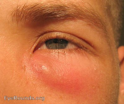 Atlas Entry - Dacryocystitis