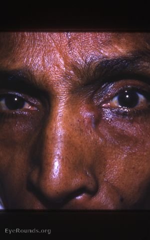 Chronic dacryocystitis