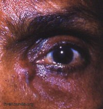 Chronic dacryocystitis