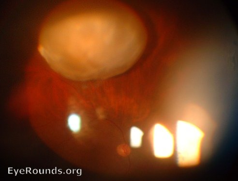 Dislocated cataractous lens. EyeRounds.org: Online Ophthalmic Atlas