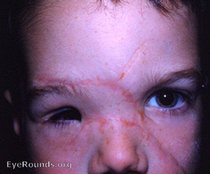 Facial (including lids) scarring with distortion from auto accident ...