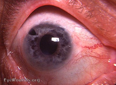 Cataract with Fuchs' heterochromic cyclitis. EyeRounds.org: Online ...