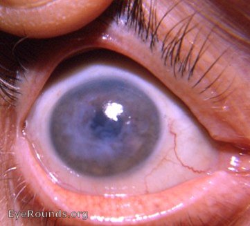 Fuch's Endothelial Corneal Dystrophy. EyeRounds.org: Online Ophthalmic ...