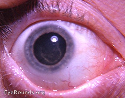 Cataract with Fuchs' heterochromic cyclitis. EyeRounds.org: Online ...