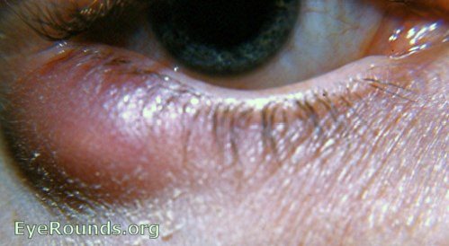 Subsiding acute meibomianitis going into the chalazion stage. EyeRounds ...