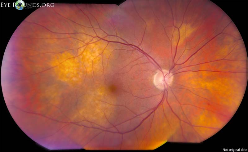 Metastatic Lung Cancer. Online Atlas of Ophthalmology :: The University ...