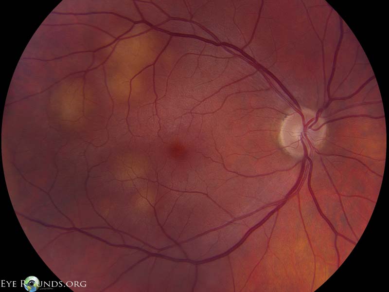 Metastatic Lung Cancer. Online Atlas of Ophthalmology :: The University ...