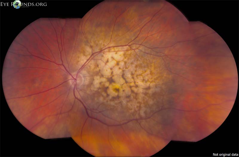Metastatic Lung Cancer. Online Atlas of Ophthalmology :: The University ...