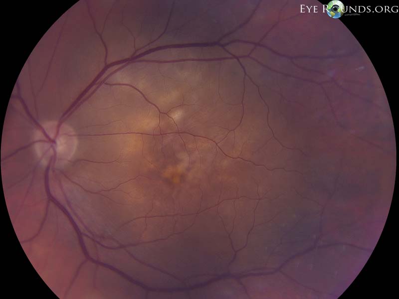Metastatic Lung Cancer. Online Atlas of Ophthalmology :: The University ...