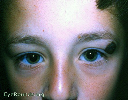 Pigmented nevus - left upper lid near outer canthus. EyeRounds.org ...