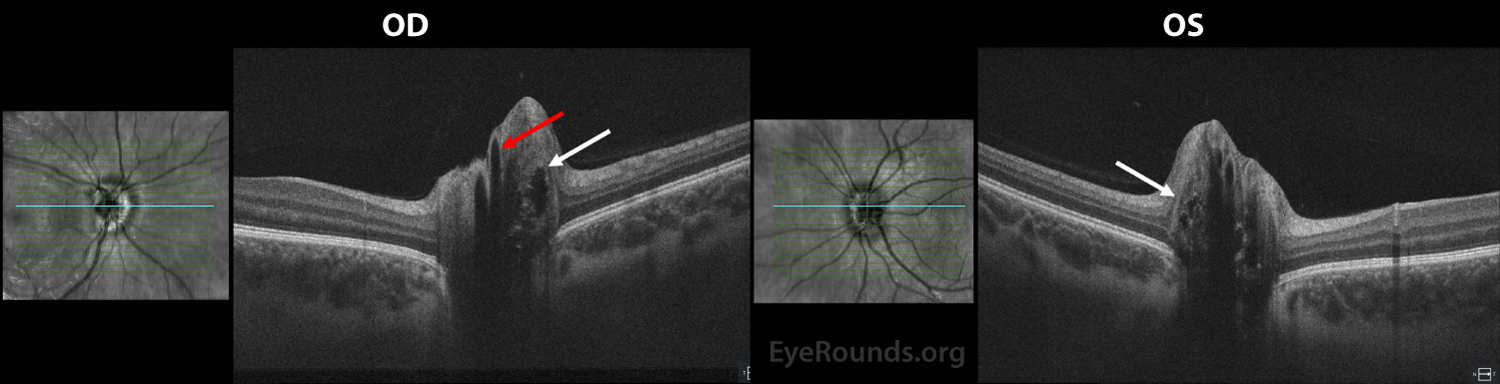 Optic Disc Drusen. EyeRounds.org: Online Ophthalmic Atlas