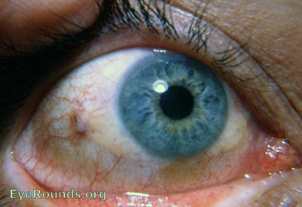 Pigmented nevus of bulbar conjunctiva. EyeRounds.org: Online Ophthalmic ...