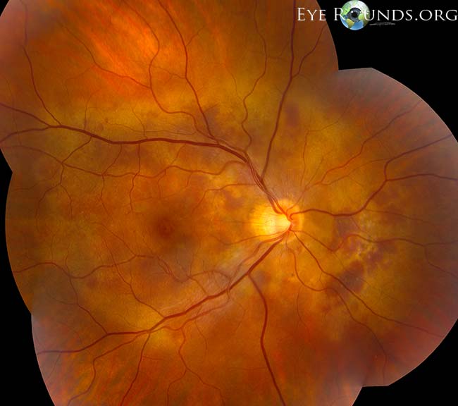 Polypoidal choroidal vasculopathy (PCV): The University of Iowa ...