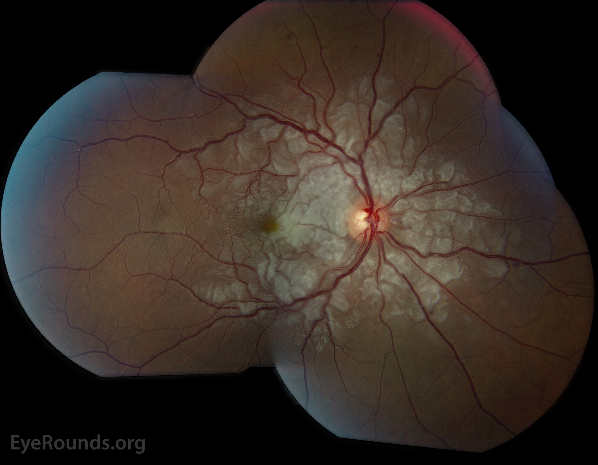 Purtscher Retinopathy