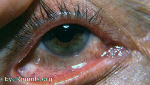 Slitting of inferior canaliculus. EyeRounds.org: Online Ophthalmic Atlas