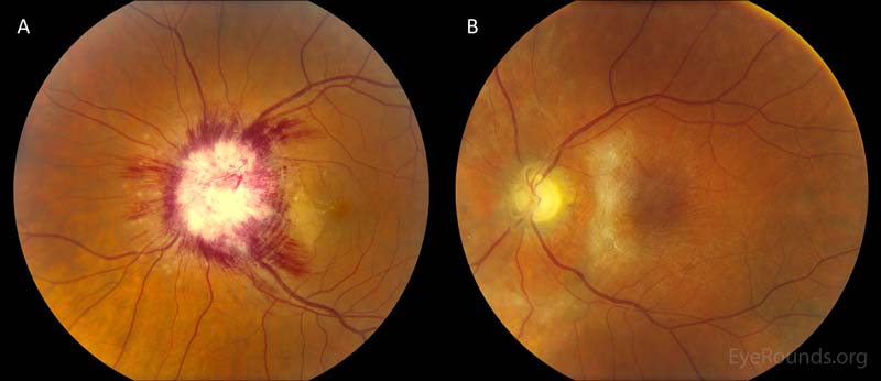 Ocular Syphilis Presenting with Posterior Subcapsular Cataract ...
