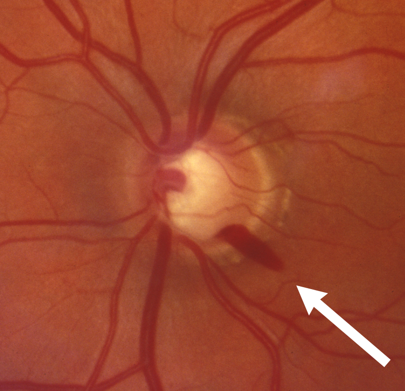 Optic Nerve Eye Hemorrhage at Eula Seay blog