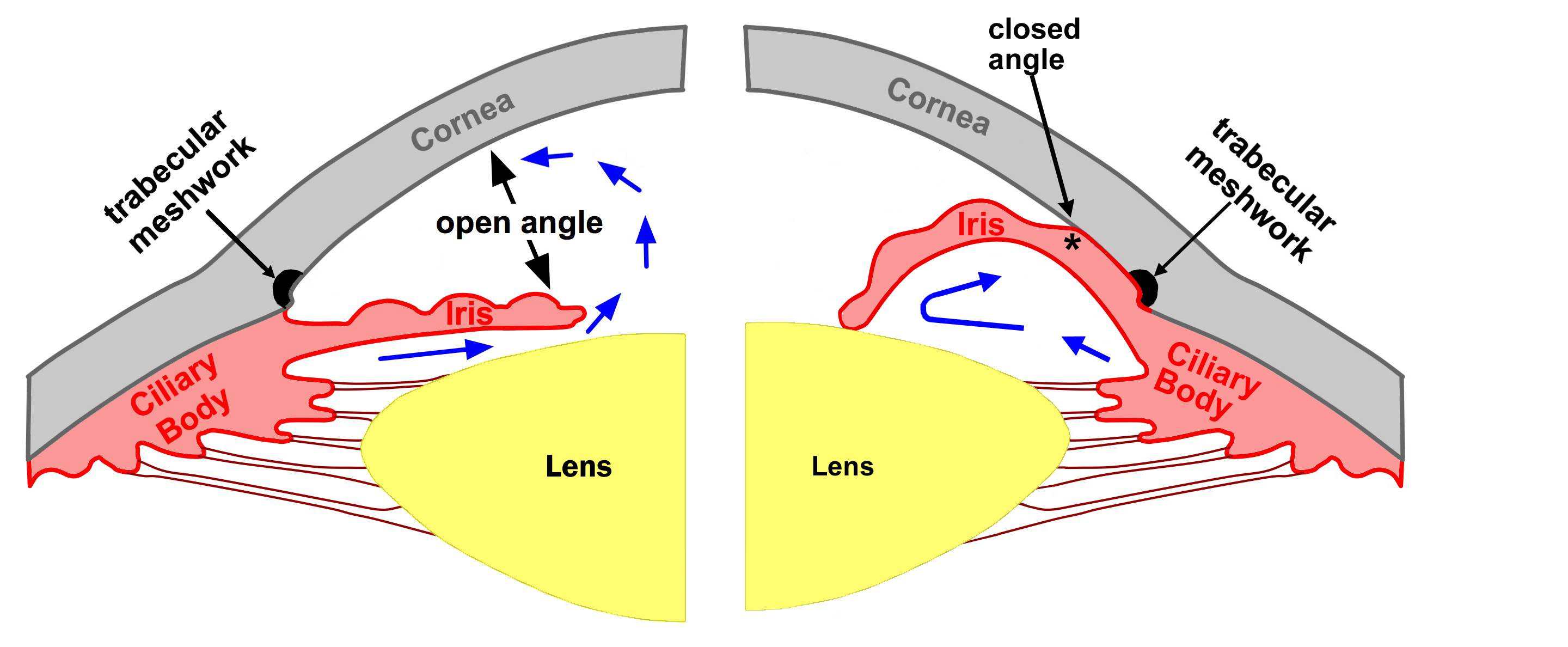 Ch 4 Types of Glaucoma. A Patient's Guide to Glaucoma