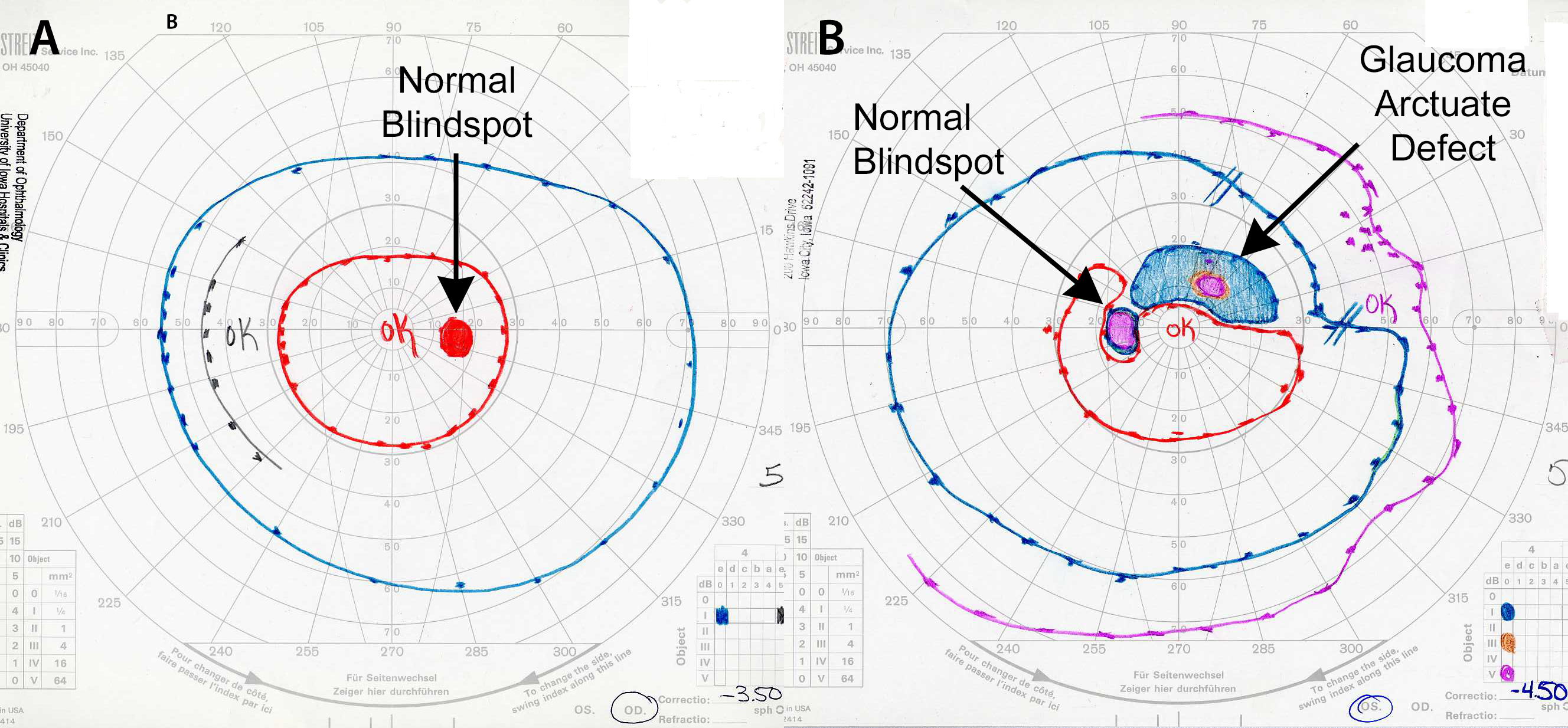 Ch 6 The glaucoma eye examination and diagnosis. A Patient's Guide to ...