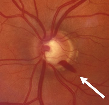 Ch 6 The glaucoma eye examination and diagnosis. A Patient's Guide to ...