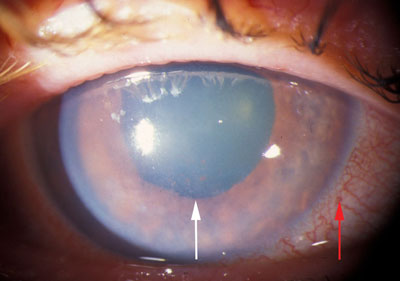 Ch 9. Glaucoma Emergency: Acute angle closure glaucoma. A Patient's ...
