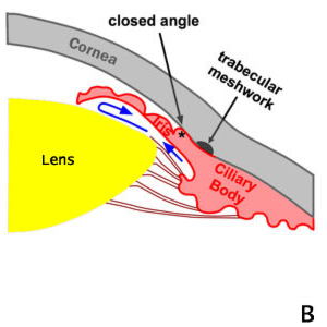 Ch 9. Glaucoma Emergency: Acute angle closure glaucoma. A Patient's ...