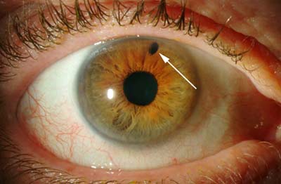 Ch 9. Glaucoma Emergency: Acute angle closure glaucoma. A Patient's ...