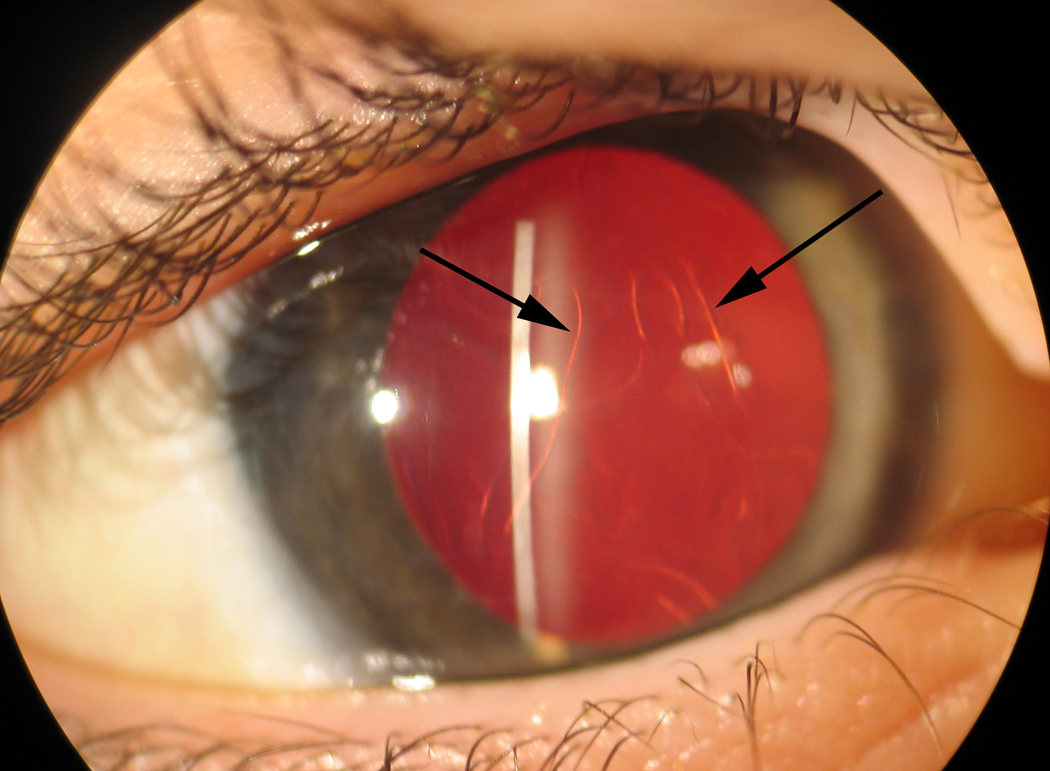 Ch 10 Pediatric Glaucoma. A Patient's Guide to Glaucoma