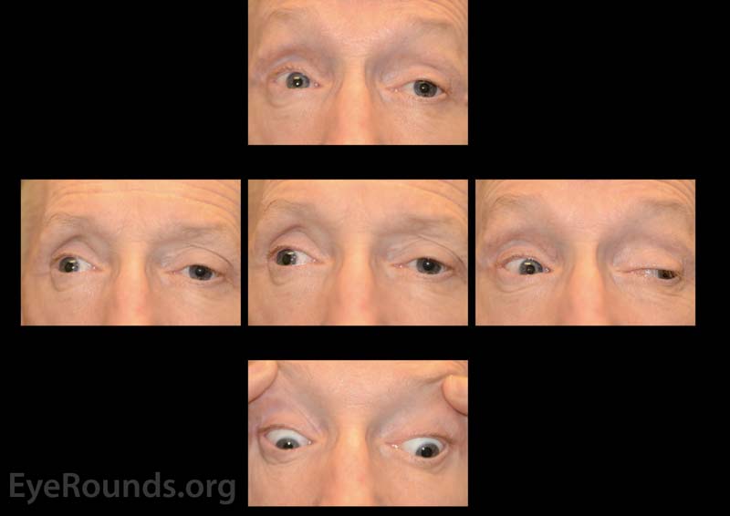 Carotid Cavernous Fistula