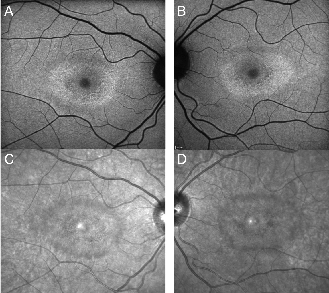 Hydroxychloroquine Plaquenil Toxicity And Recommendations For Screening