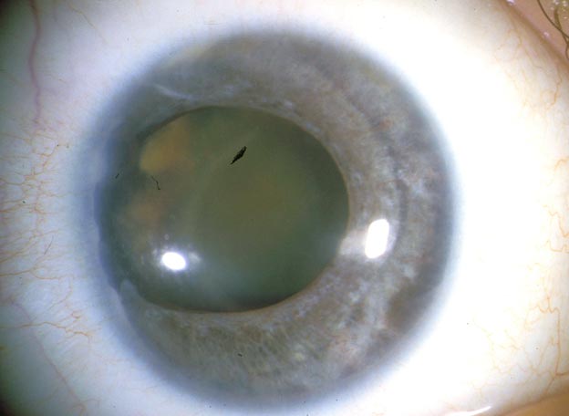 Axenfeld-Rieger Syndrome with Cataract : The University of Iowa ...