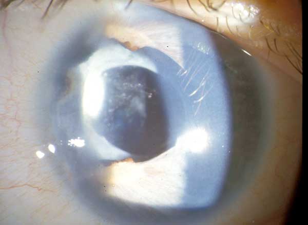 Axenfeld-Rieger Syndrome with Cataract : The University of Iowa ...