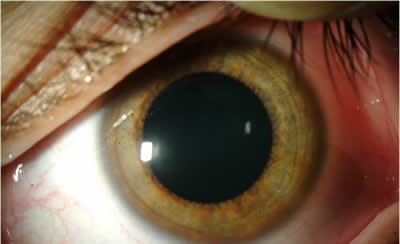 Phlyctenular Keratoconjunctivitis. EyeRounds.org - Ophthalmology - The ...