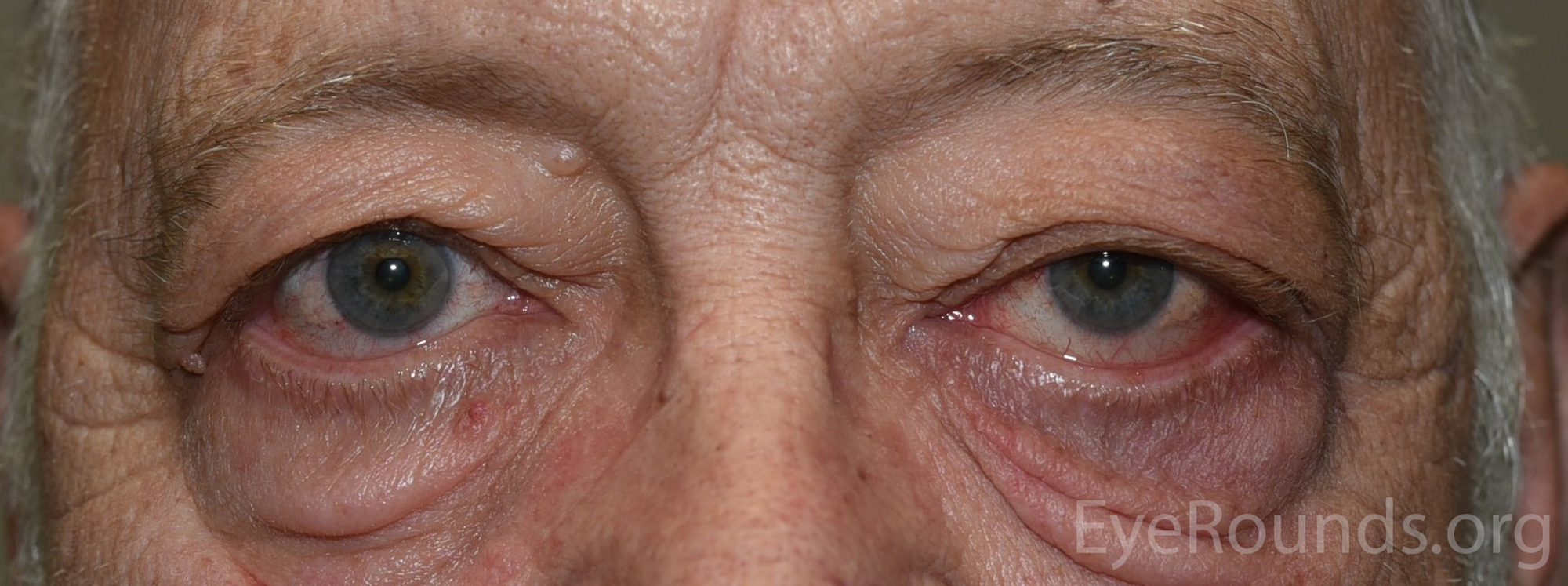 EyeRounds.org: orbital lymphoma