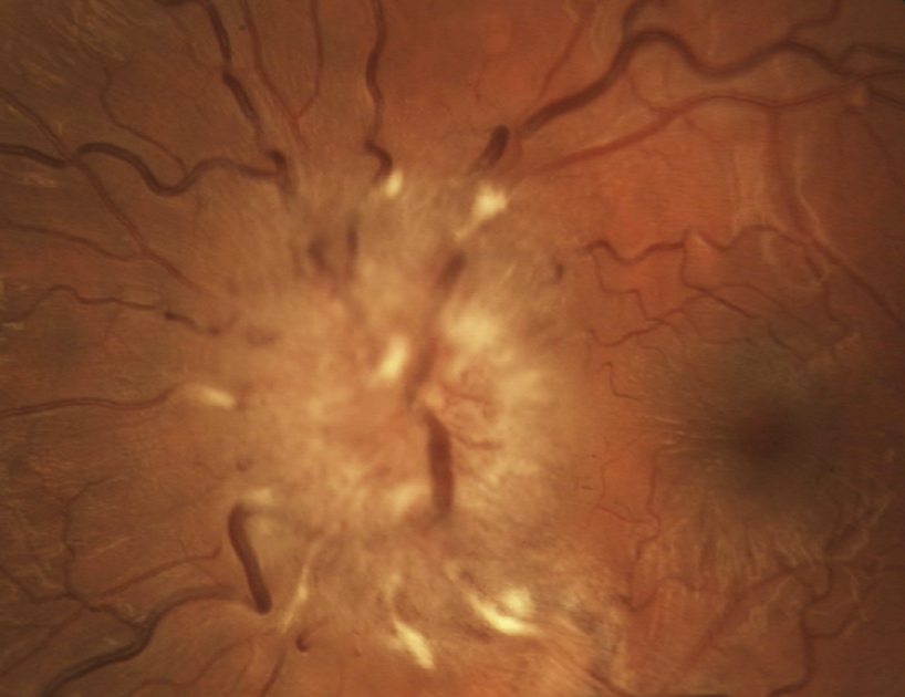 Papilledema Grades. EyeRounds.org - Ophthalmology - The University of Iowa