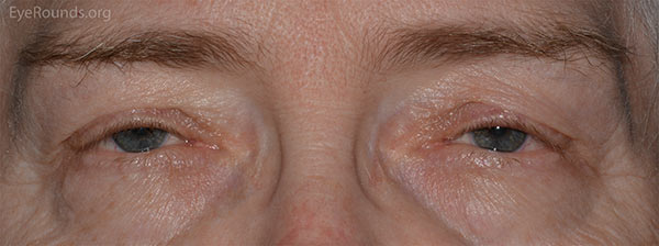 A Primer on Ptosis