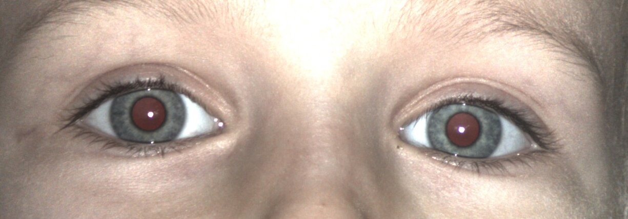 Vision Screening for Amblyopia