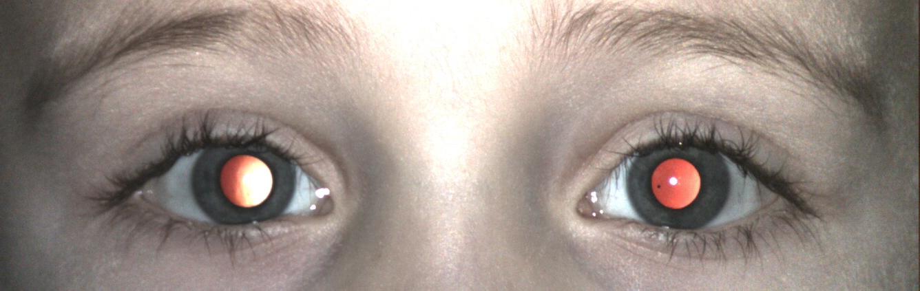 Vision Screening for Amblyopia