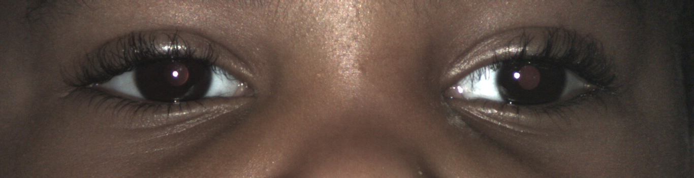 Vision Screening for Amblyopia